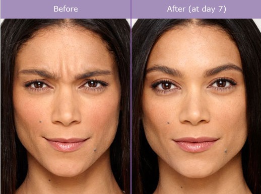 Botox Wrinkle Reduction Huntsville Alabama | Cosmetic Surgery